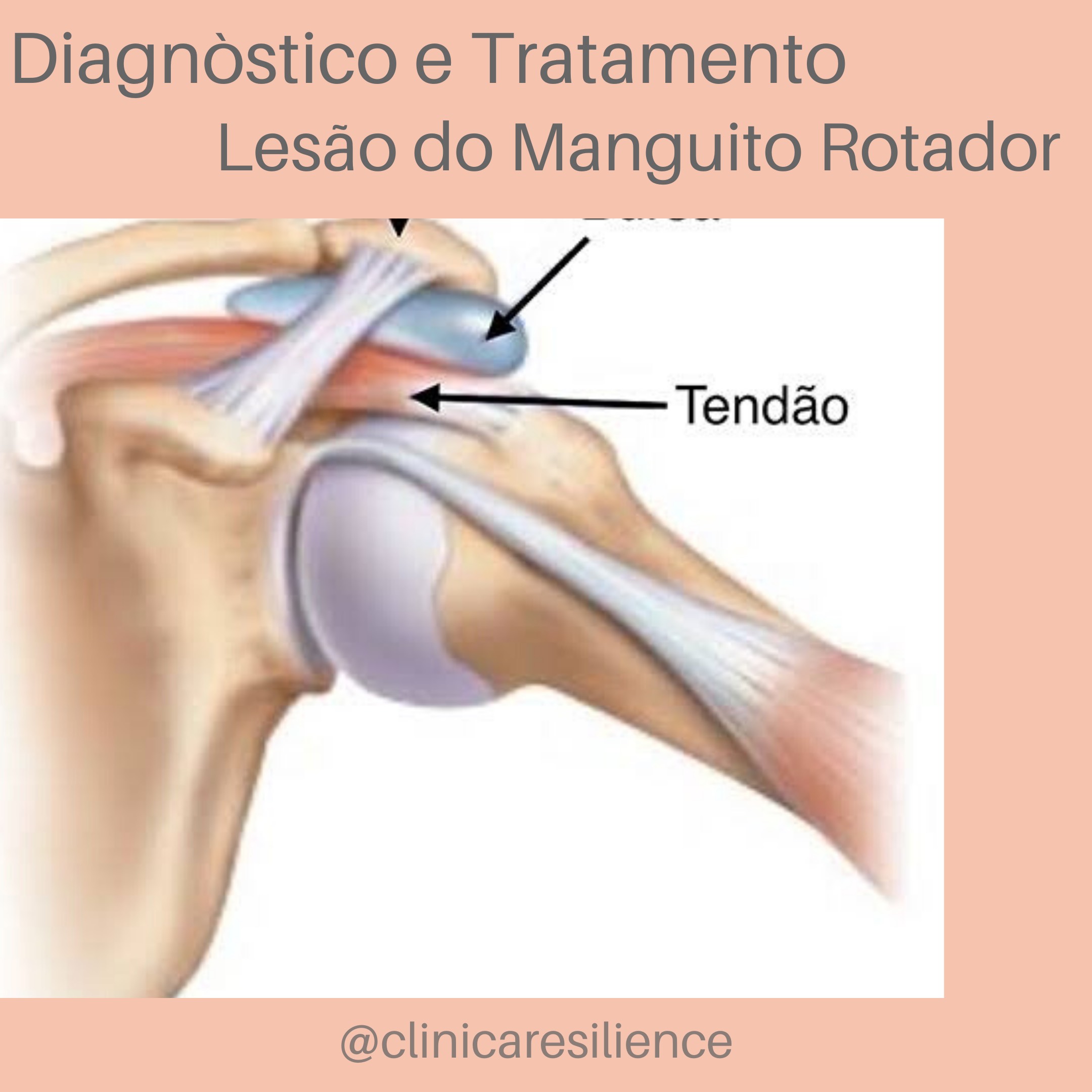 Lesão do Manguito Rotador | Clínica Resilience Lesão do Manguito Rotador | Clínica Resilience
